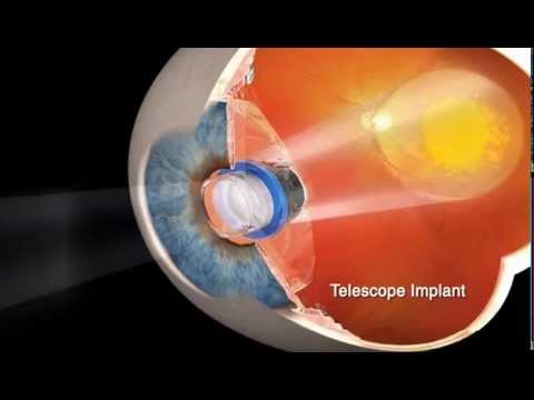 IMT Mechanism of Action Video on website - YouTube
