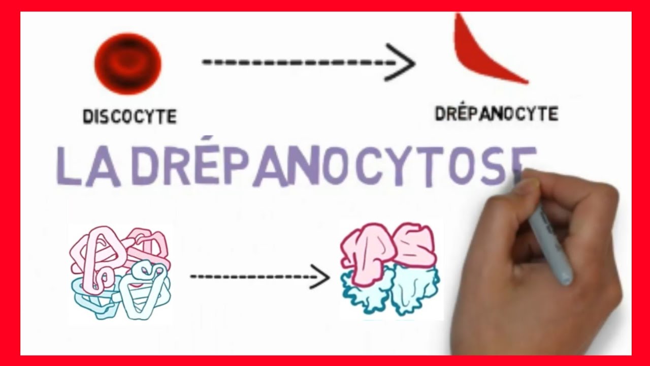 Drépanocytose : physiopathologie, symptômes, traitement - YouTube