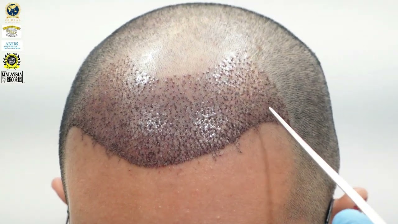 Hair Transplant Journey Day 2 Hair Transplant Malaysia Hair Clinic