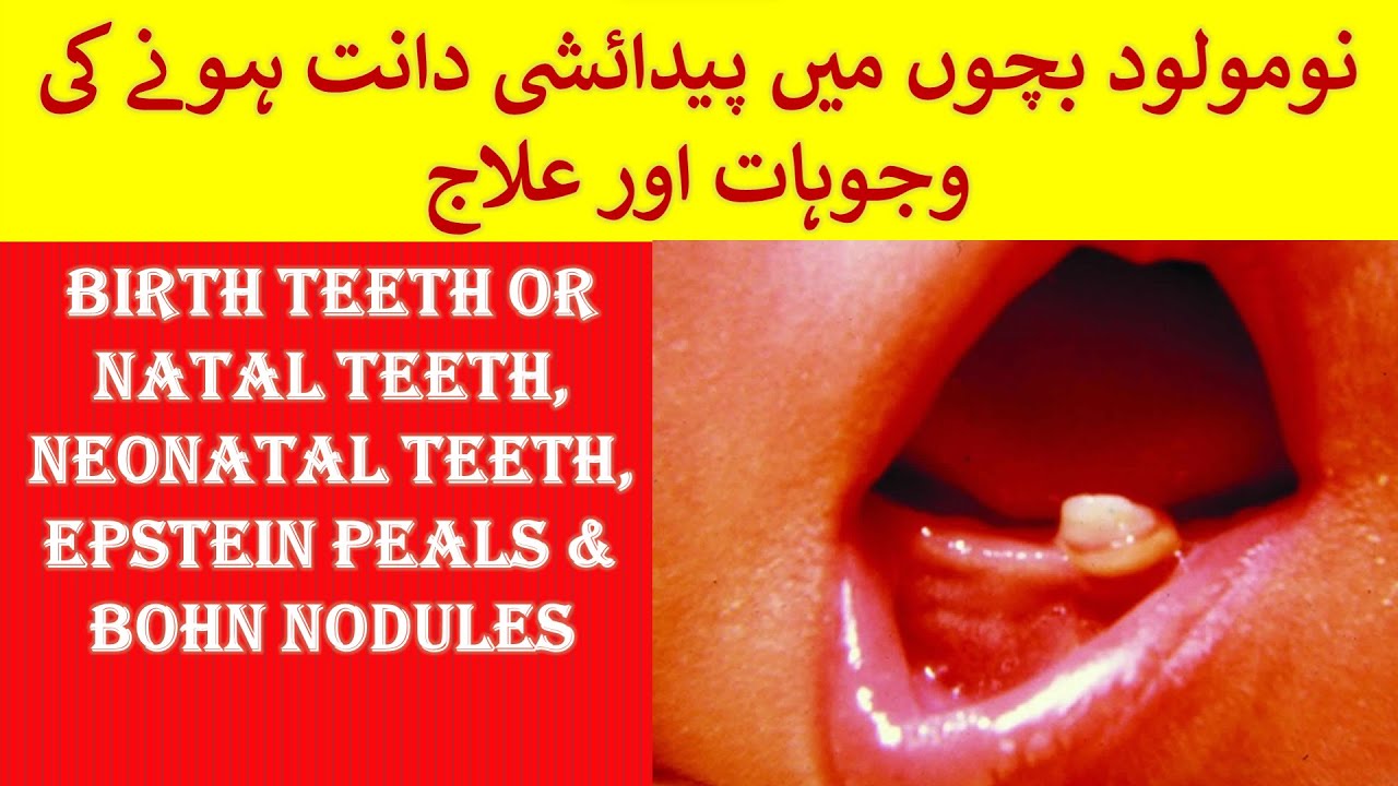 Birth or Natal Teeth, Neonatal Teeth, Epstein Peals & Bohn Nodules ...
