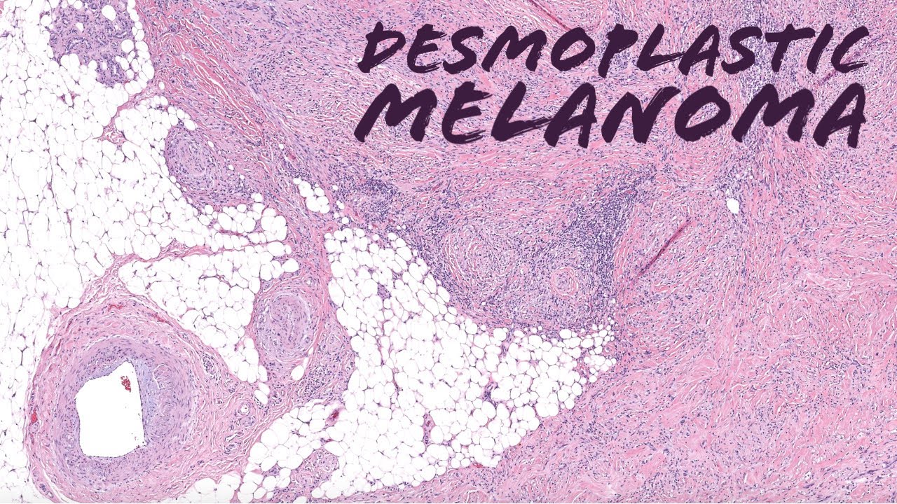 Desmoplastic Melanoma with Immunohistochemistry (UNC Case 1) dermpath ...