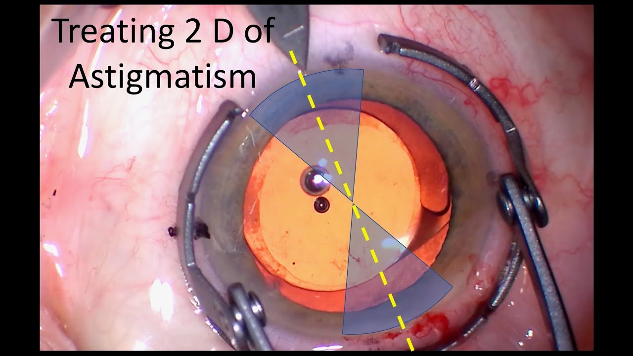 Cataract Surgery with Superior Phaco Incision and Paired Astigmatic ...