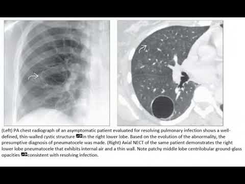 Pneumatocele radiology - YouTube