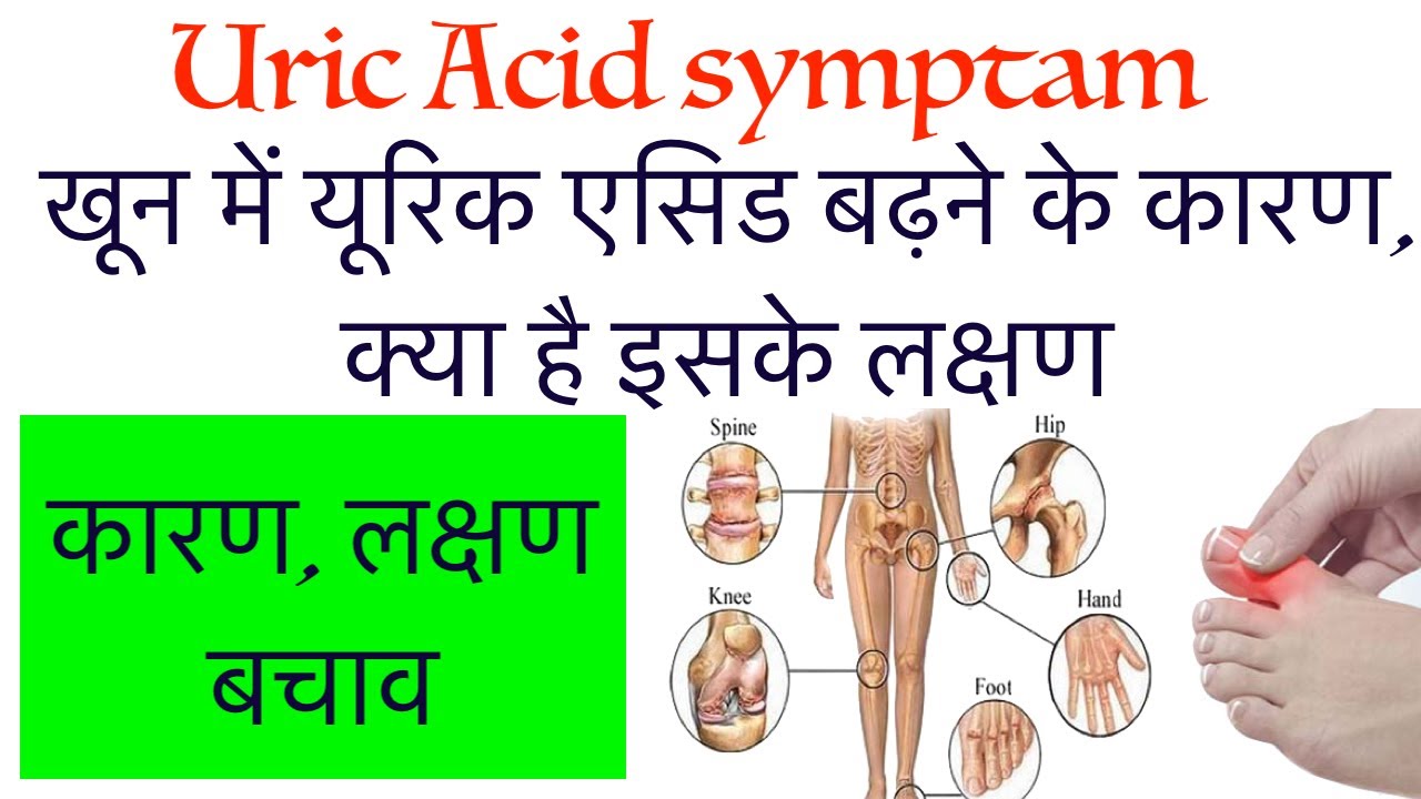 Uric Acid Symptoms,How To Reduce Uric Acid Levels,Gout,Herbal Gout ...