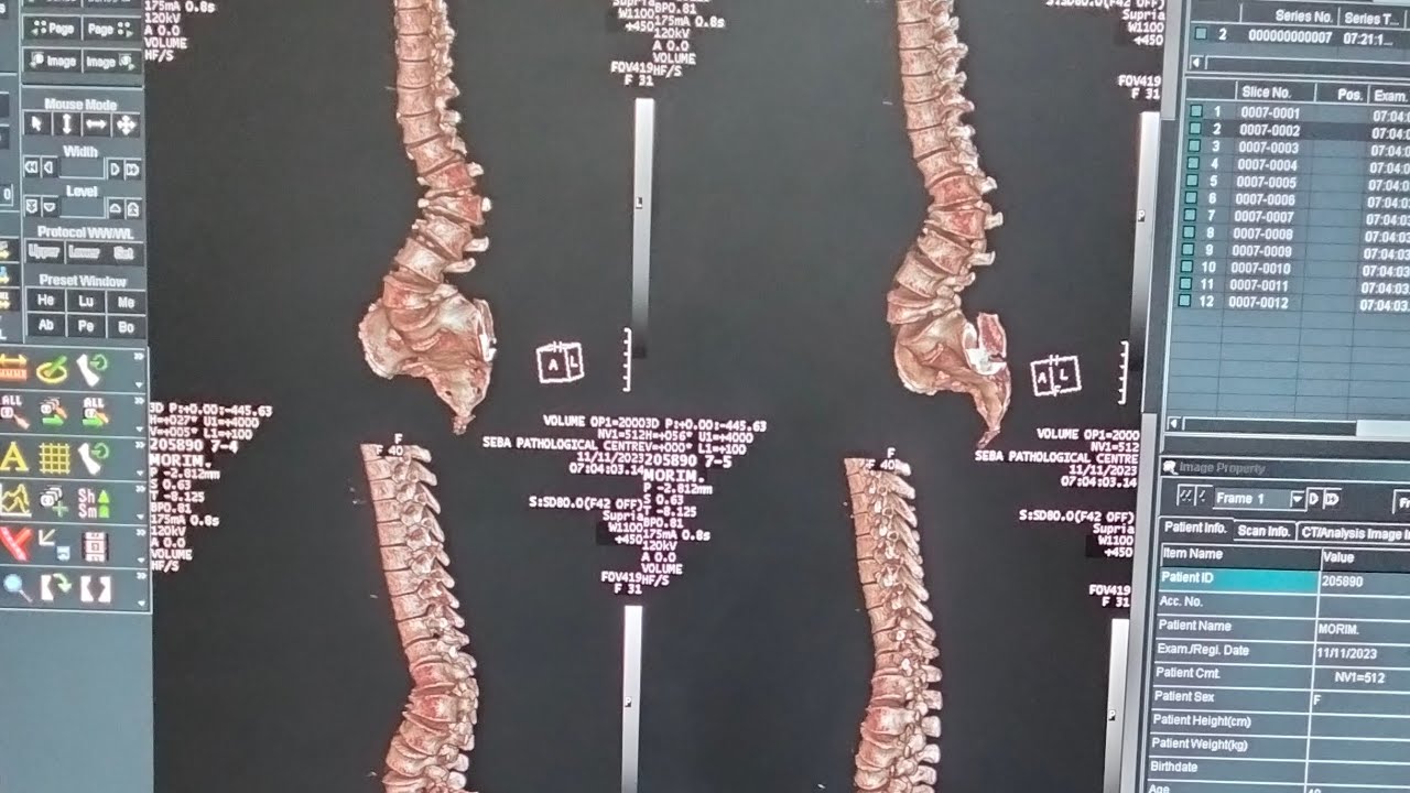 Ct scan of Lumber Spine 3D - YouTube