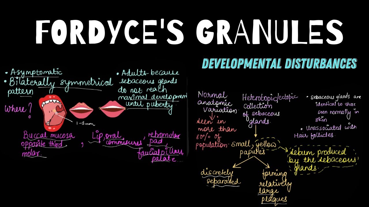 Fordyce’s Granules Explained | Characteristics, Causes & Developmental ...