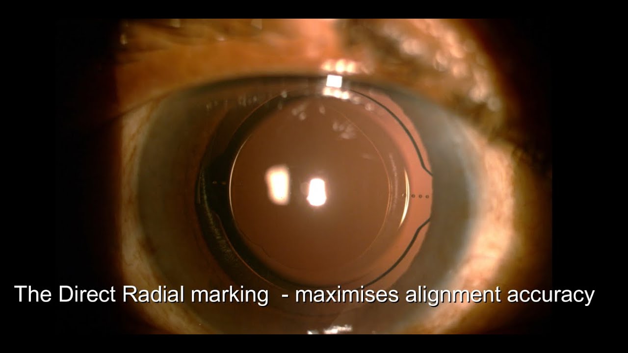 Get perfect Toric IOL alignment with the direct radial ink less marking ...