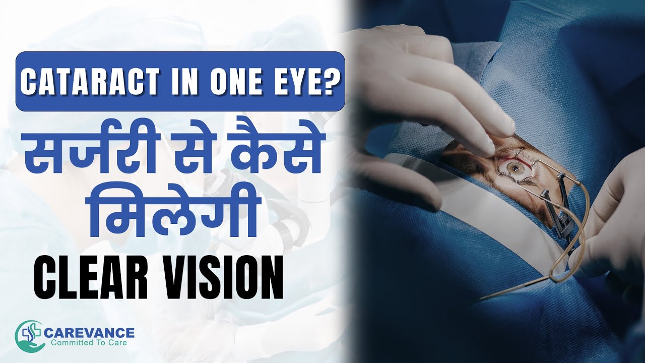 Cataract in One Eye? सर्जरी से कैसे मिलेगी Clear Vision #cataract # ...