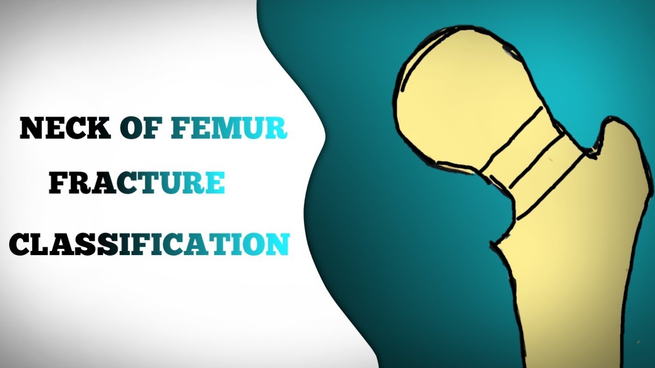 Neck of femur fracture classification made easy #femurfracture # ...