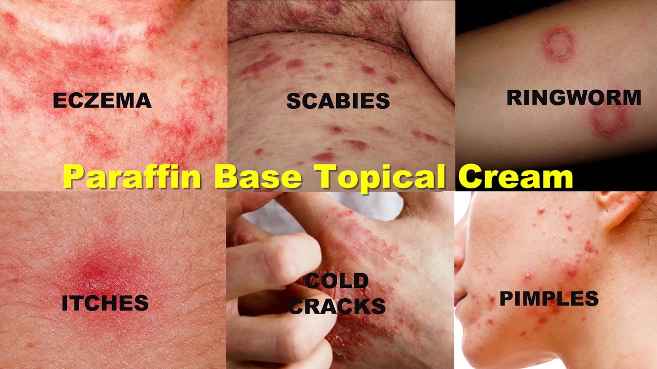 RMCL : DermaTex Ointment - YouTube