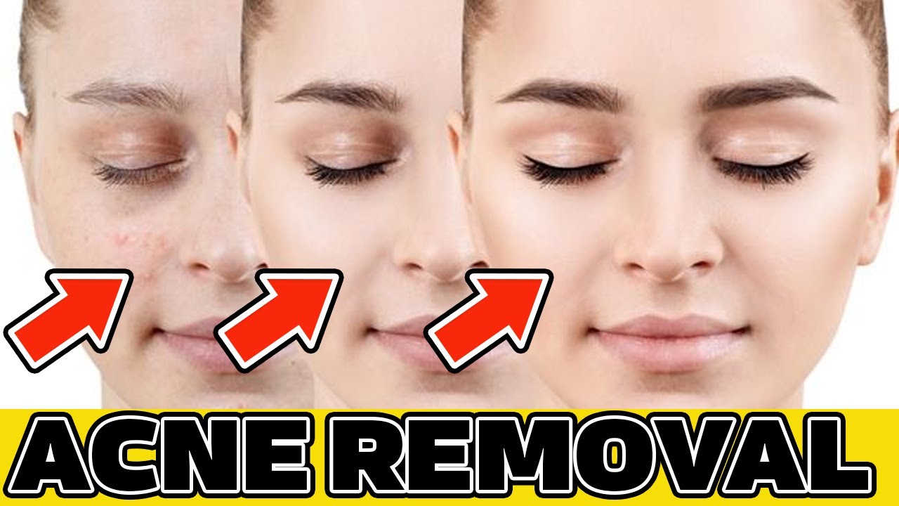 HOW TO GET RID OF PIMPLES & ACNE AT HOME || how to get rid of a sore ...
