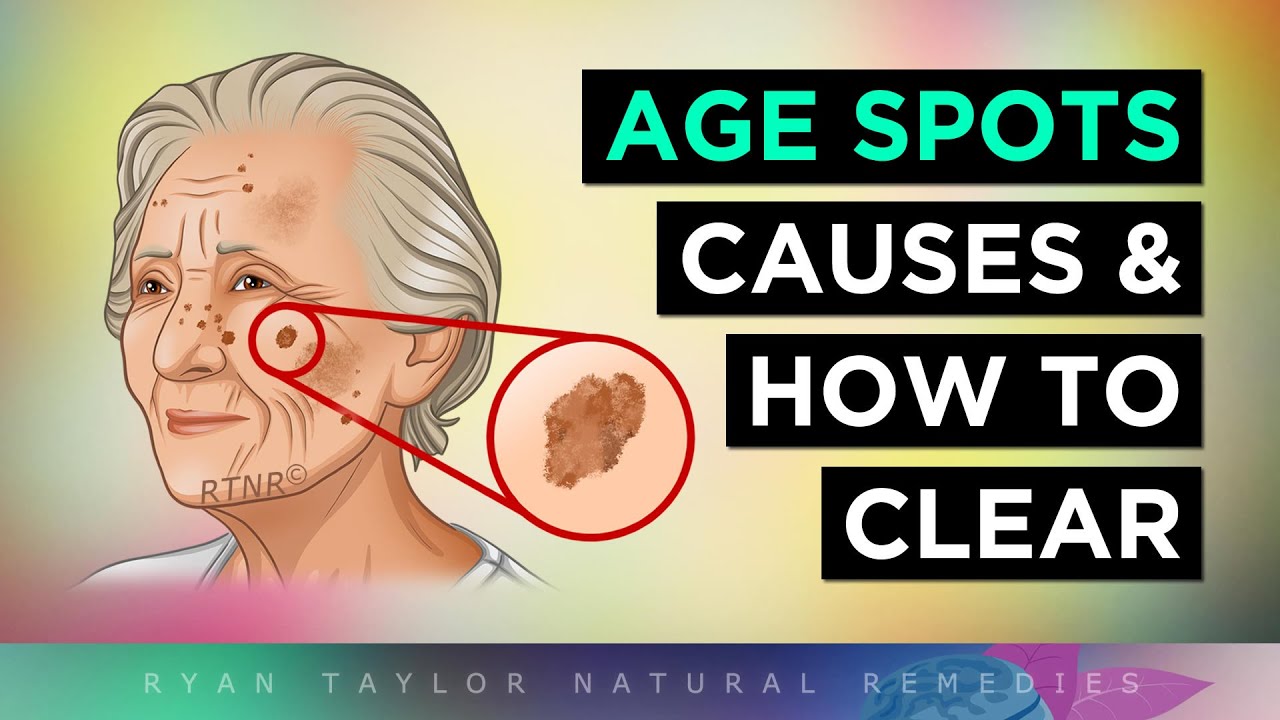 The Real Causes of AGING SPOTS - YouTube