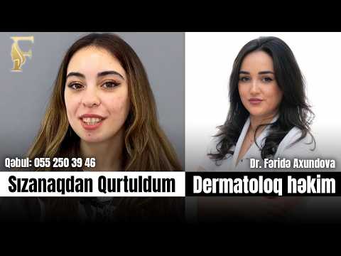 Sızanaqdan Qurtulma Hekayəm – Müalicə və Nəticə