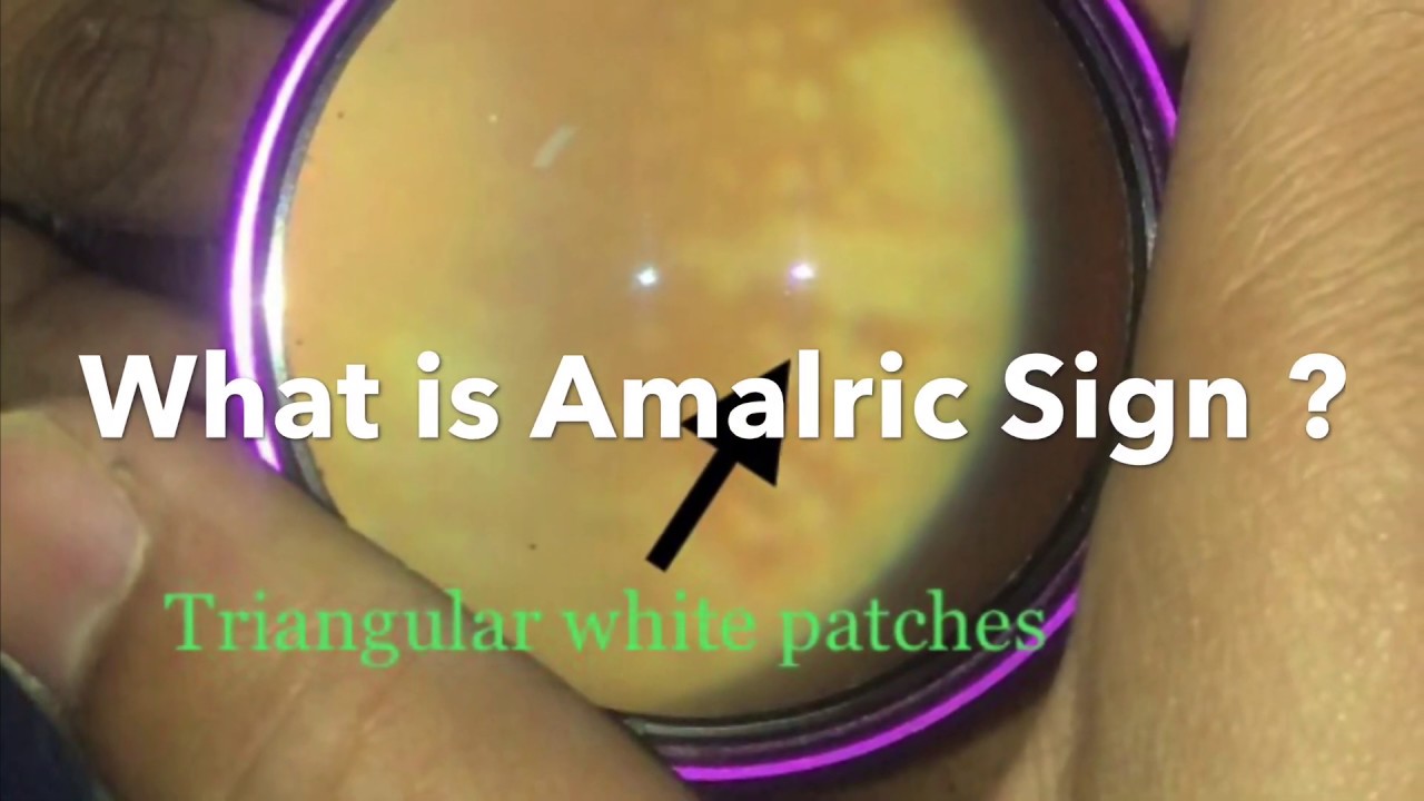 Amalric Sign // Choroidal ischmeia // wedge shaped yellowish areas ...