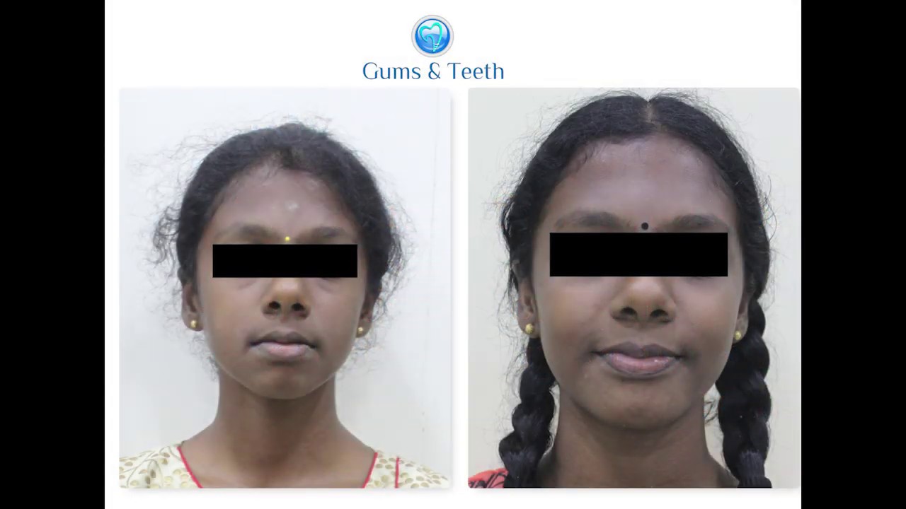 Correction Smile of the Patient by Orthodontic Treatment - YouTube