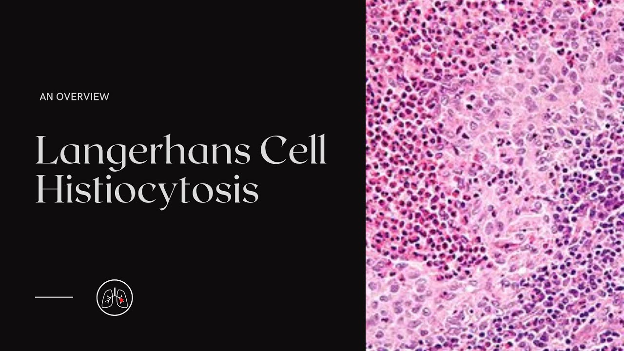 Langerhans Cell Histiocytosis Skin
