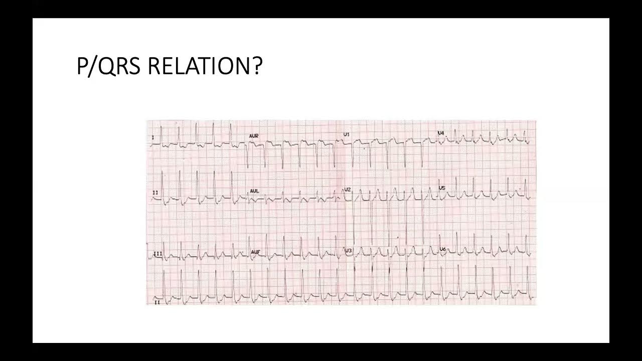 Basic ECG & Introduction to Arrythmias (2/2) Dr Mohamad Maghawry - YouTube