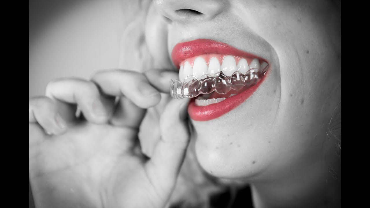 Smile out of a Box aligners! - YouTube