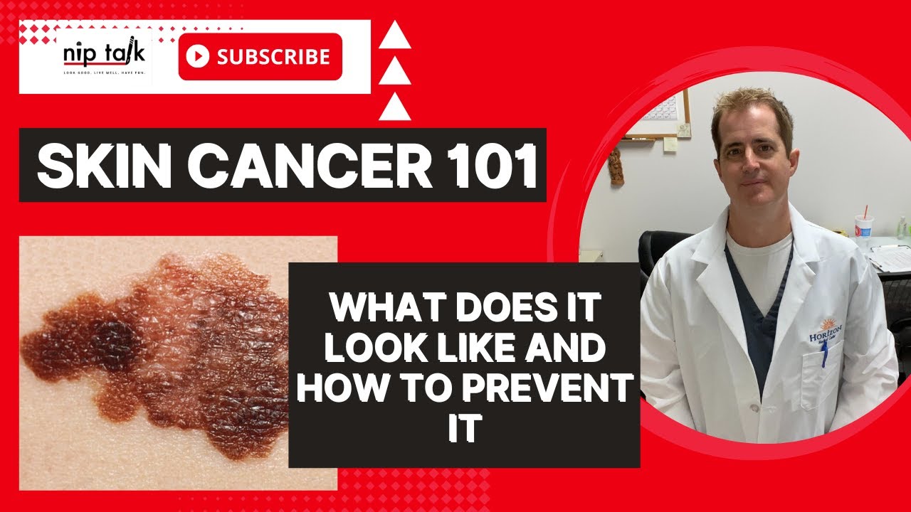 Skin Cancer 101 - What it looks like and how to prevent it! - YouTube