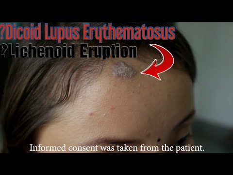 Dermatology | Approach to Hypertrophic lesion on face | Counselling ...