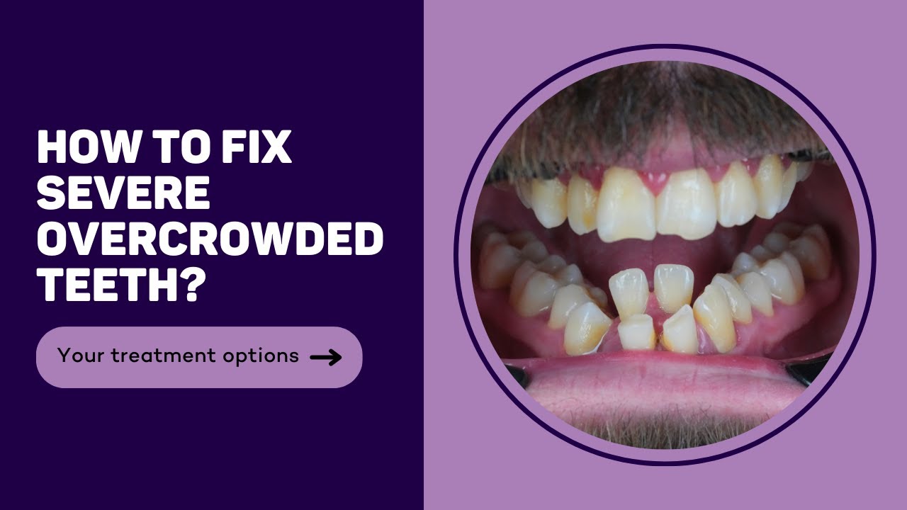 How To Fix Severe Overcrowded Teeth? - YouTube