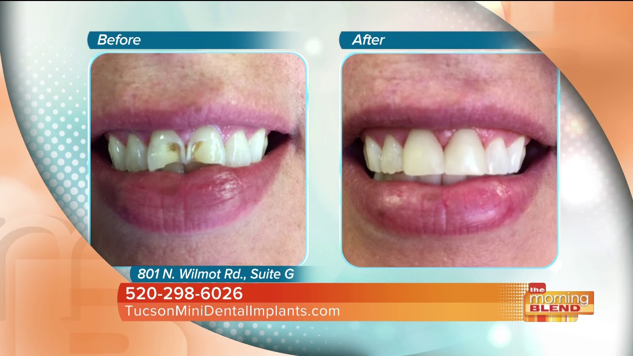 Tucson Mini Dental Implants - YouTube