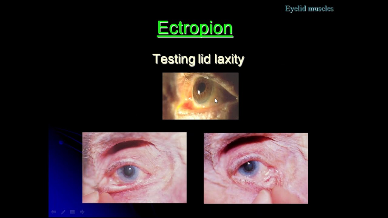 A Class On Ectropion By Dr Vivekanand,Dept Of Ophthalmology - YouTube