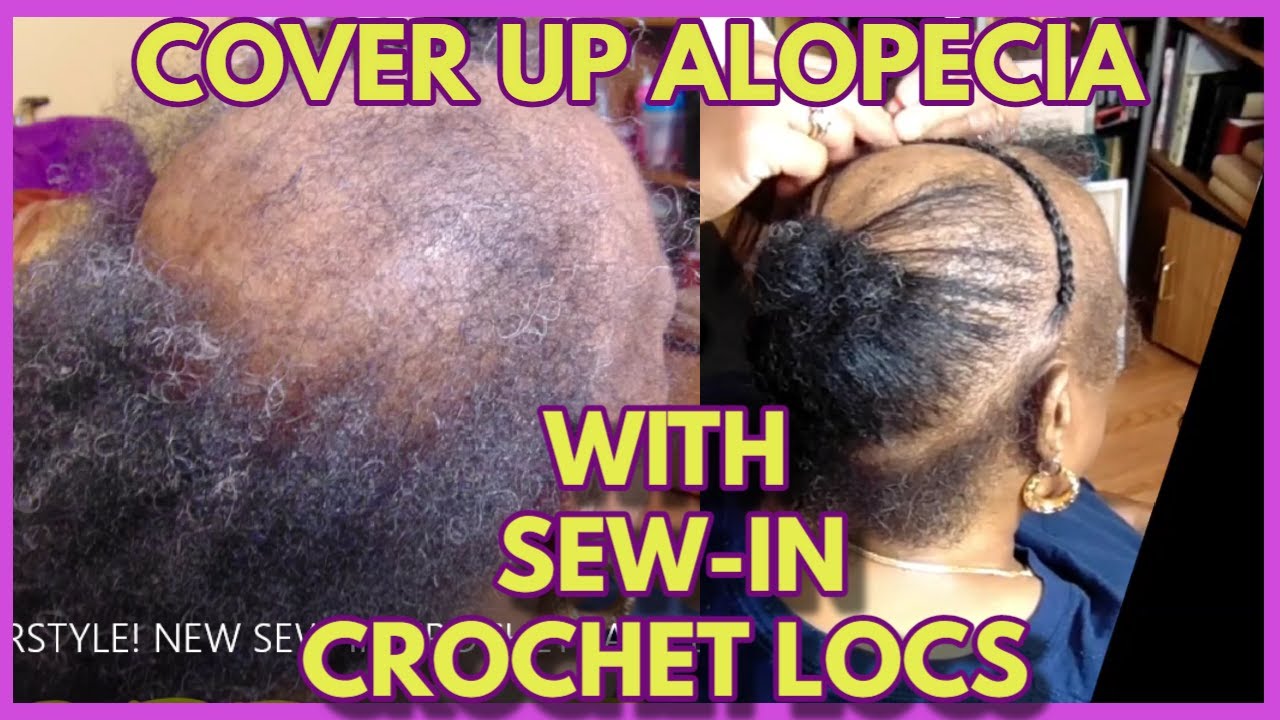 HOW TO COVER UP SEVERE ALOPECIA WITH SEW-IN CROCHET FAUX LOCS - YouTube