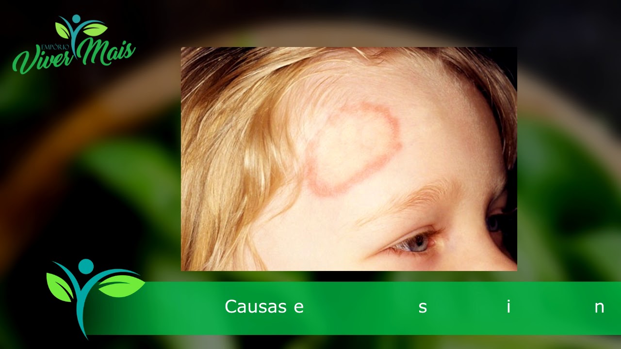 Causas e sintomas da Impingem - YouTube