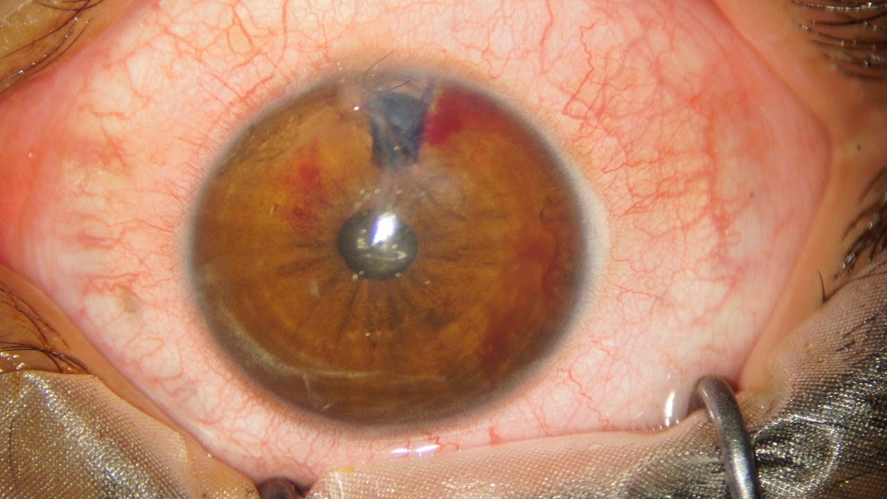 Cruciate Corneal Perforation Repair - YouTube