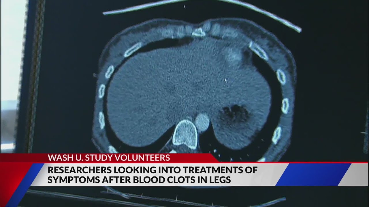 Washington University seeks volunteers for a new study of blood clots ...