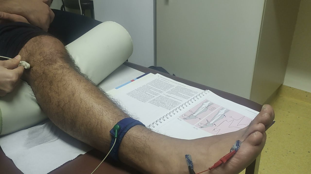 Motorische ENG: N. peroneus (Elektroneurographie) - YouTube