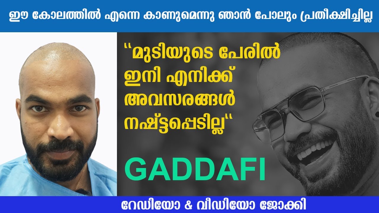 RJ & VJ Gaddafi's Hair transplant malayalam | Hair transformation | La ...