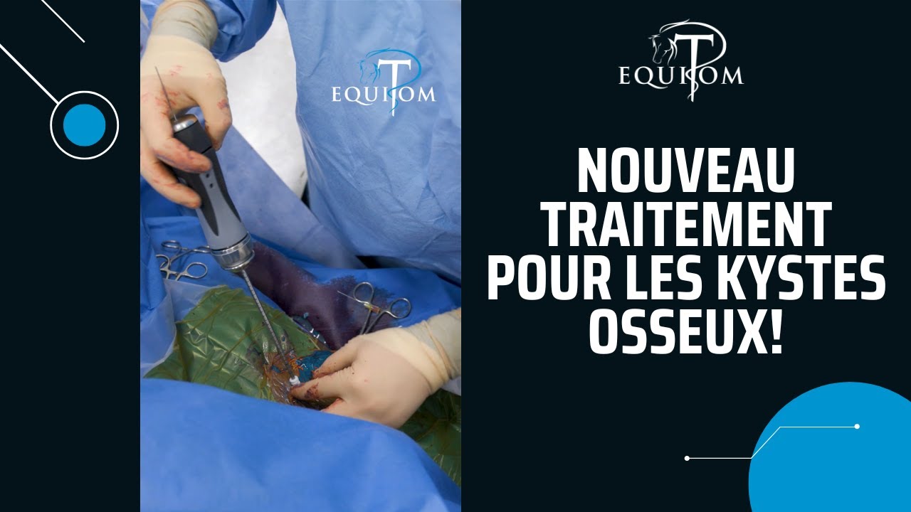 Nouveau traitement pour les Kystes osseux! Explication🎥🇫🇷🇬🇧(01:41)🇳🇱(03 ...