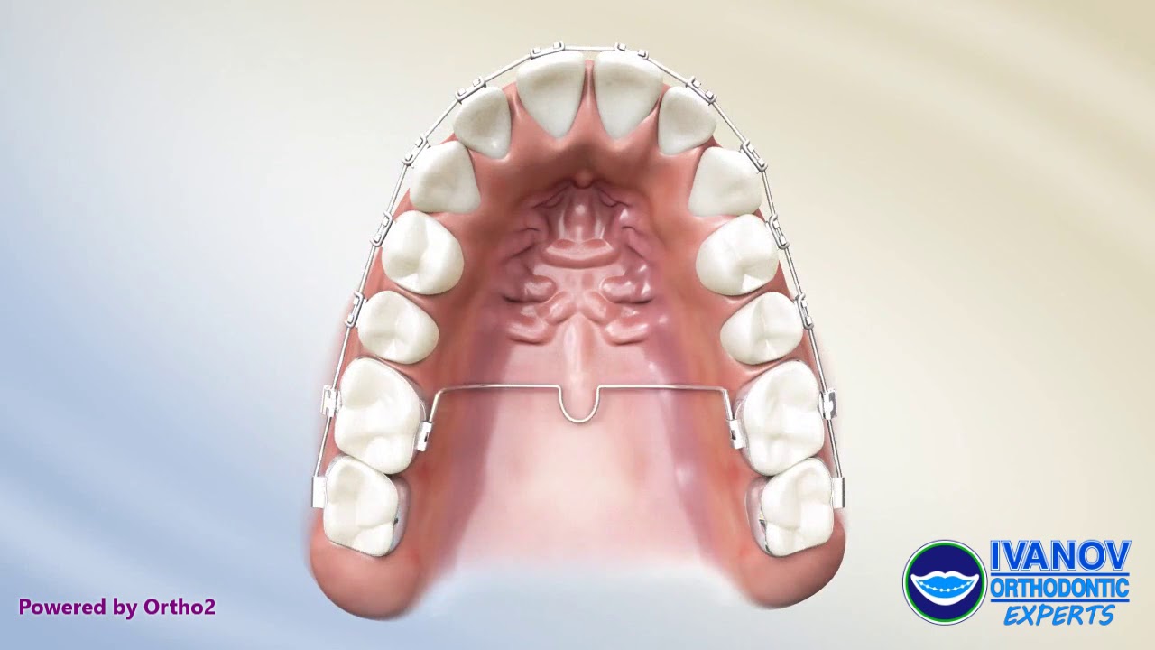 Trans Palatal Arch TPA - YouTube