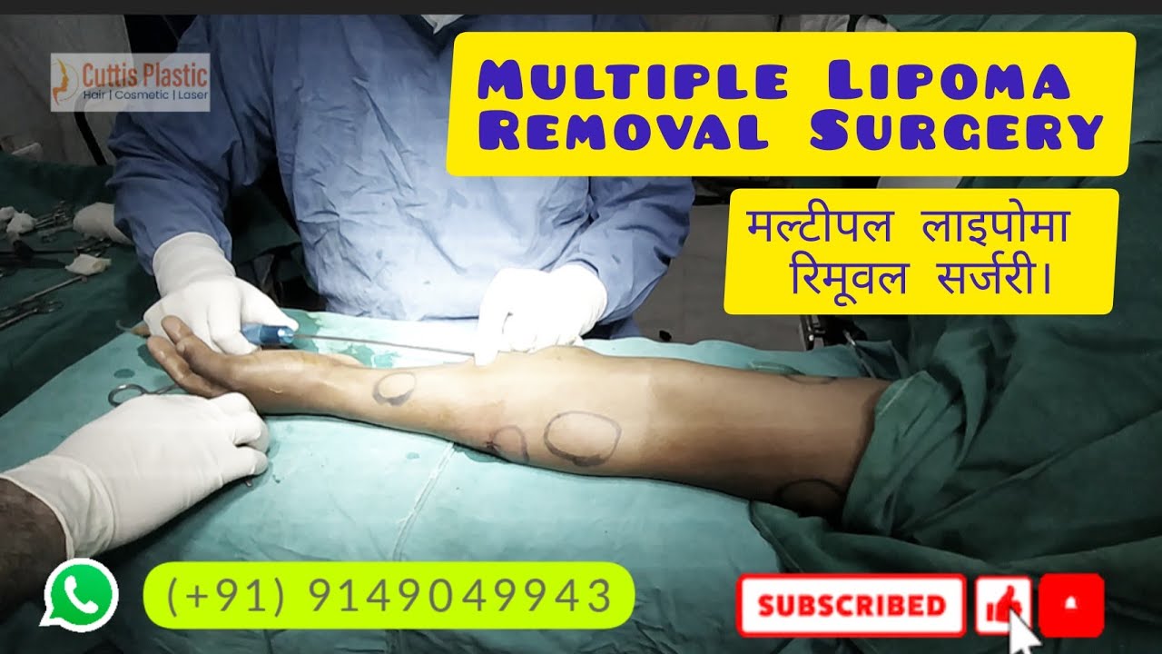 Multiple Lipoma Removal | Lipoma Surgery | Scar Less Lipoma Removal ...