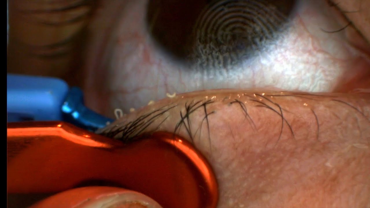 Solve Your Dry Eyes - The Amazing Meibomian Gland Expression! - YouTube