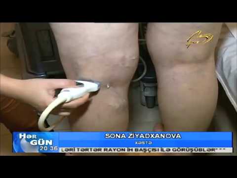 Varikoz nədir? (SpaceTv, Hər gün / Xəbərlər)