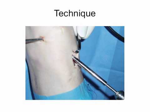 The use of bone graft during tibia fixation - YouTube