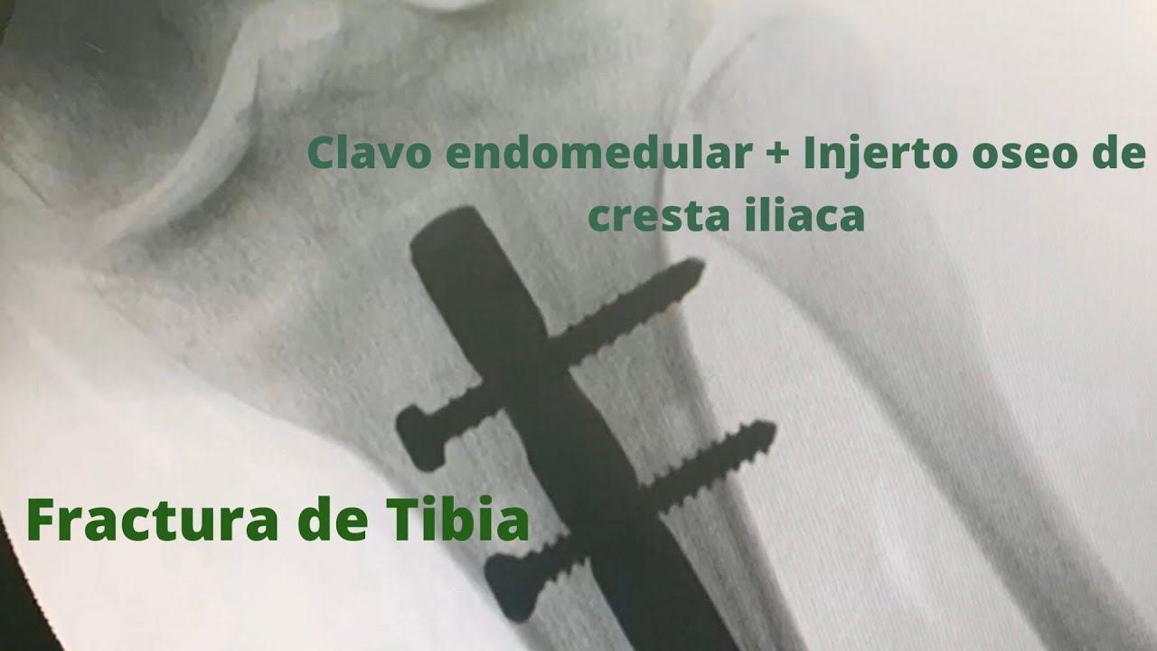 Injerto de cresta iliaca +clavo endomedular de tibia - YouTube