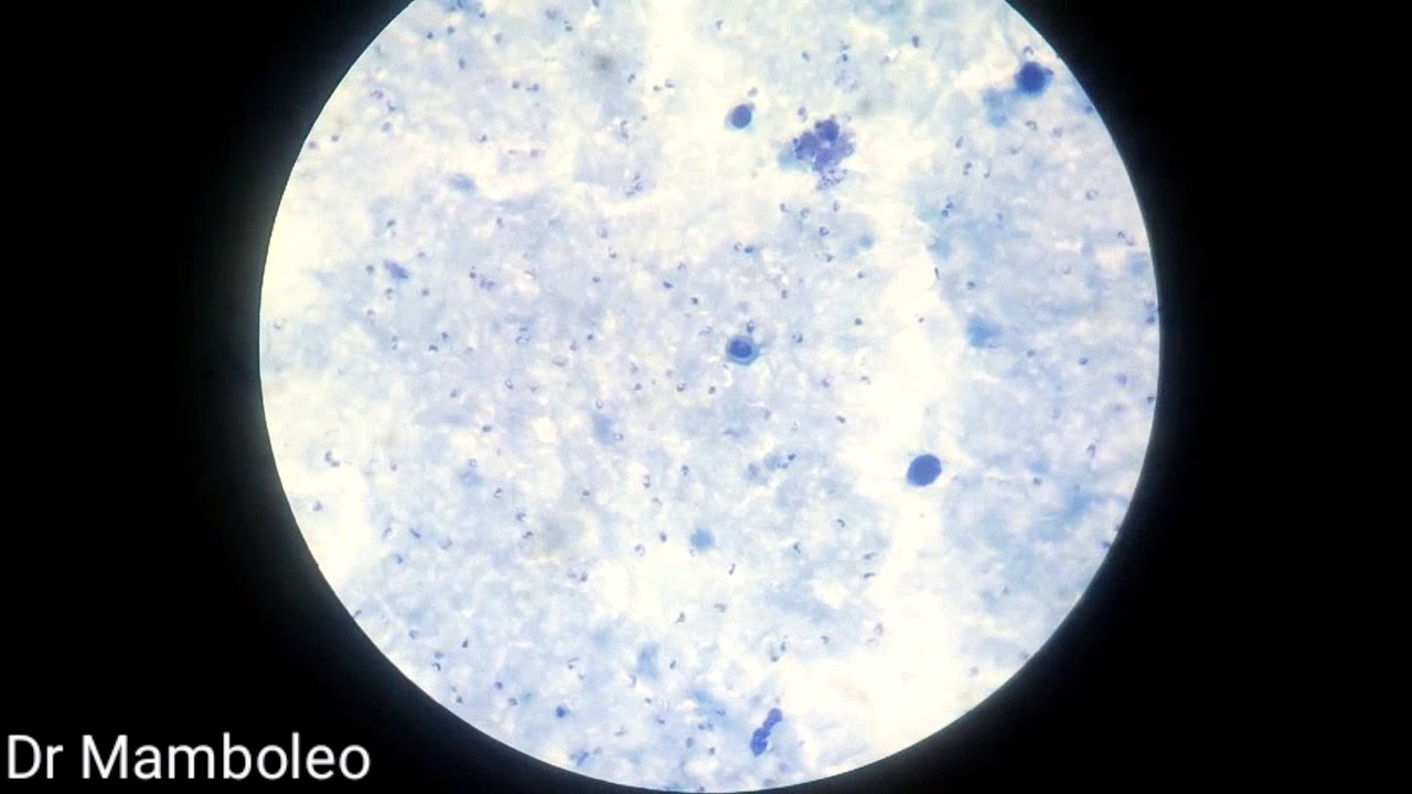 Malaria disease causing parasite under a microscope, Plasmodium ...