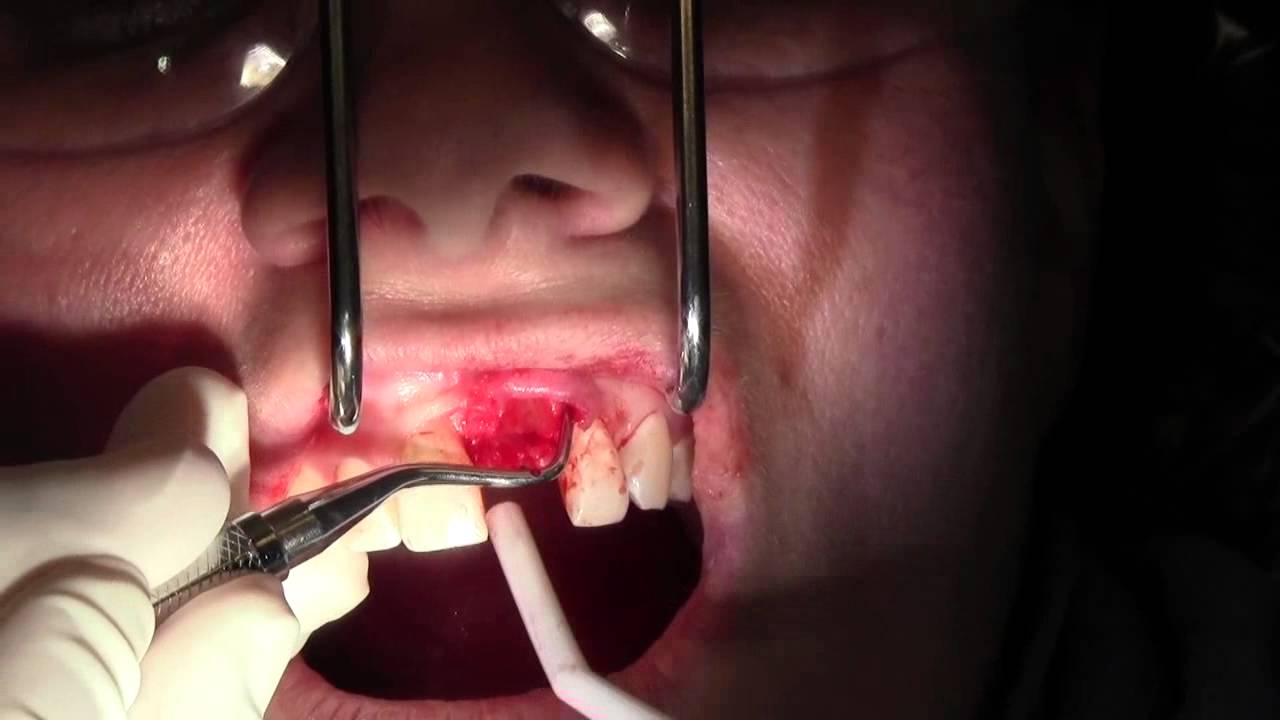 Extraction #9 with GBR-Socket Grafting, Pouch Technique, II - YouTube
