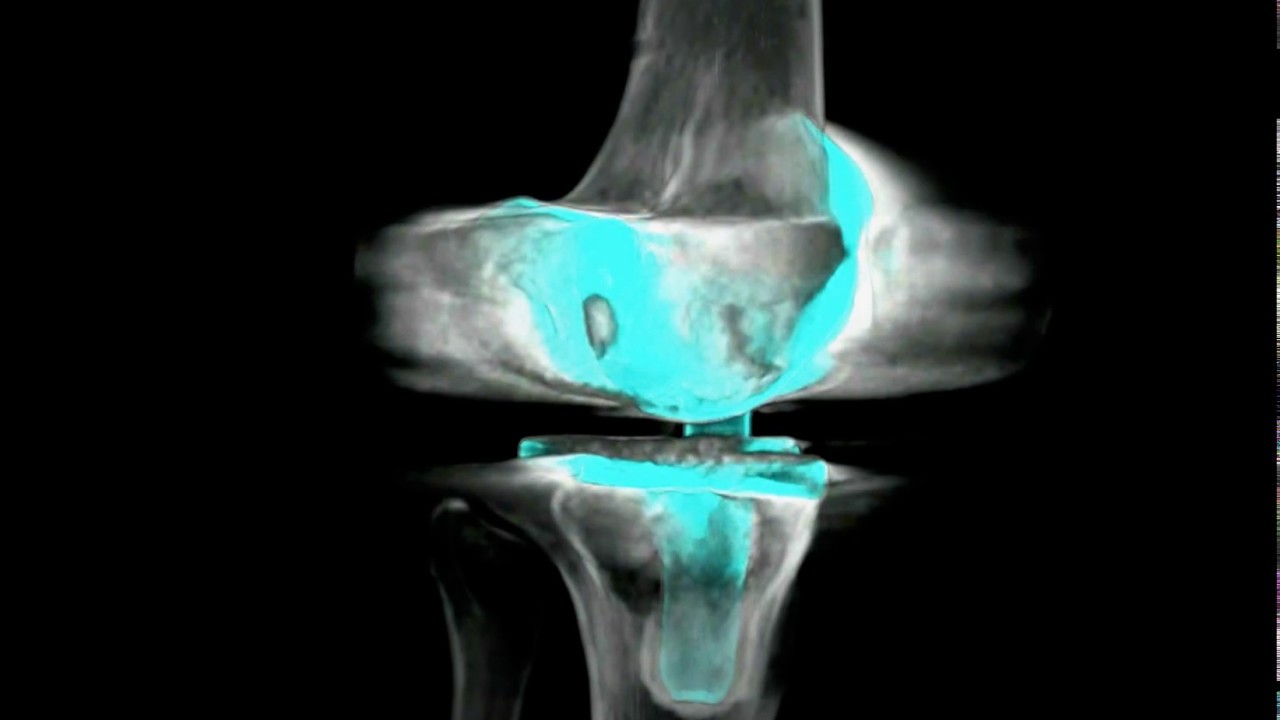 Total Knee Arthroplasty : CT finding - YouTube