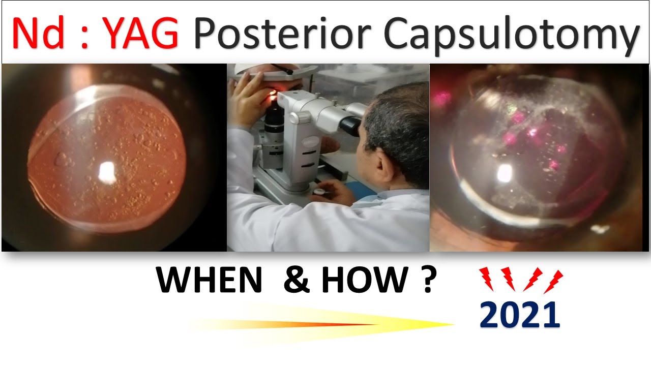 Nd-YAG Posterior Capsulotomy (#015 ) - YouTube