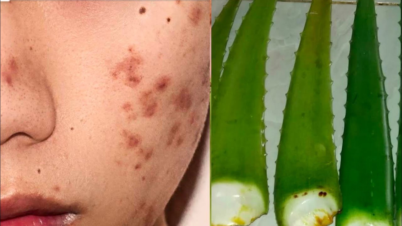 flek hitam, jerawat dan bekas jerawat hilang Selamanya dengan bahan 100 ...