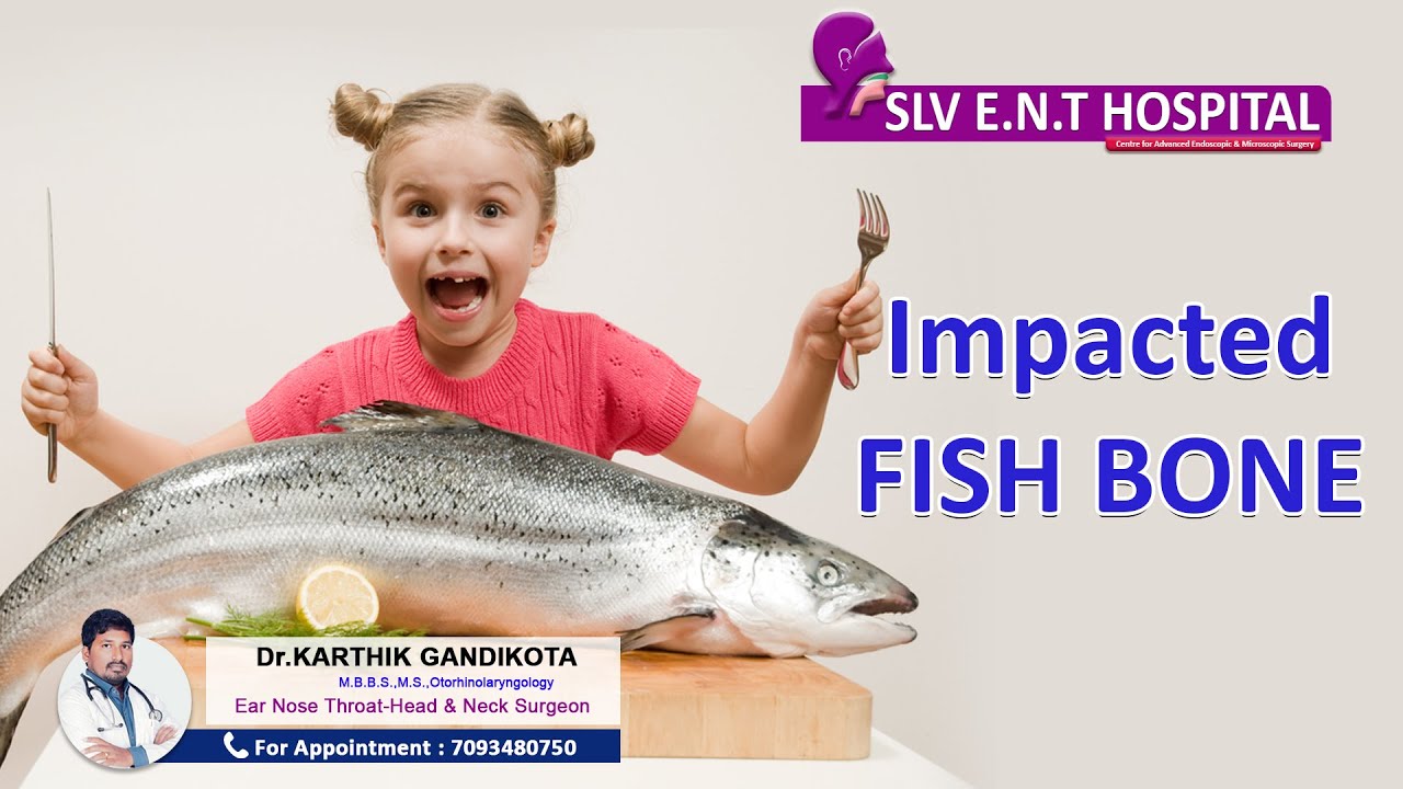 Impacted Large Fish bone - YouTube