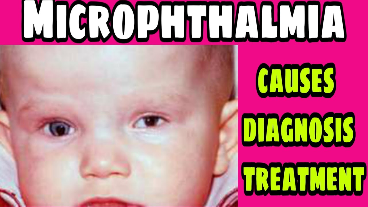 Microphthalmia: Causes, Diagnosis & treatment - YouTube