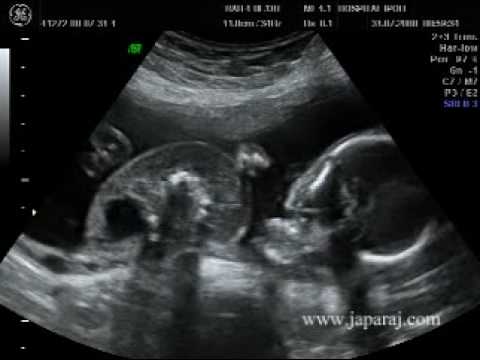 Acardiac twin (TRAP sequence) - YouTube