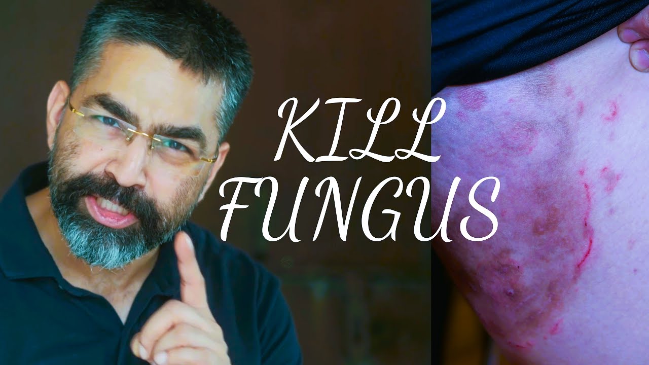 How To Get Rid of FUNGAL Infection Permanently - YouTube