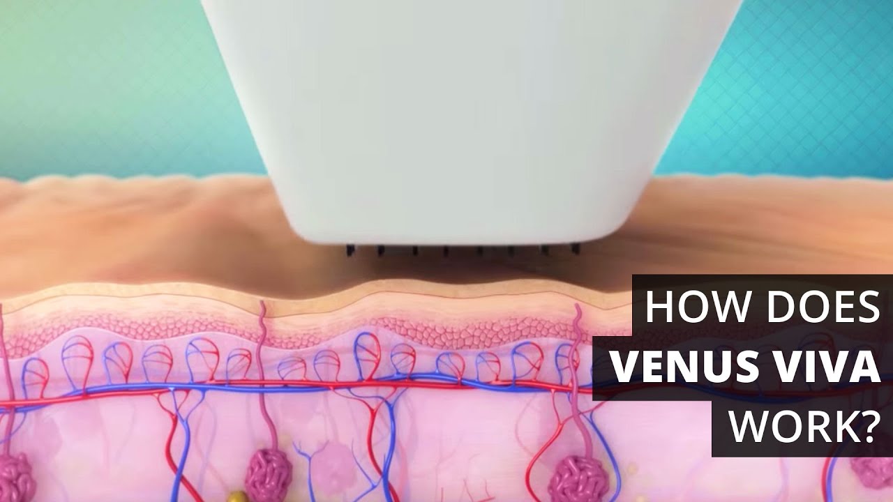 How Does Venus Viva™ Work? - YouTube